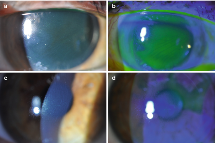Prevention and Management of Flap Striae After LASIK | Springer Nature Link