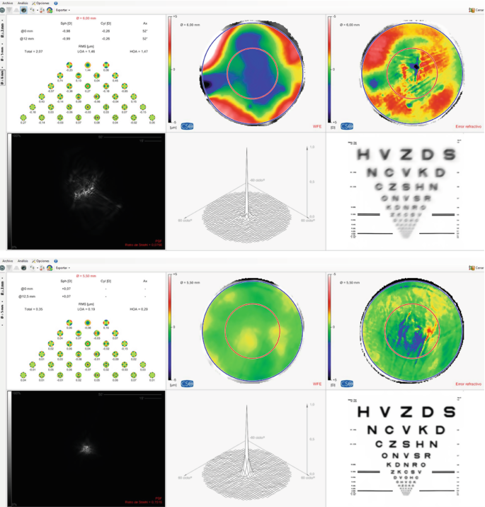 Prevention and Management of Flap Striae After LASIK | Springer Nature Link