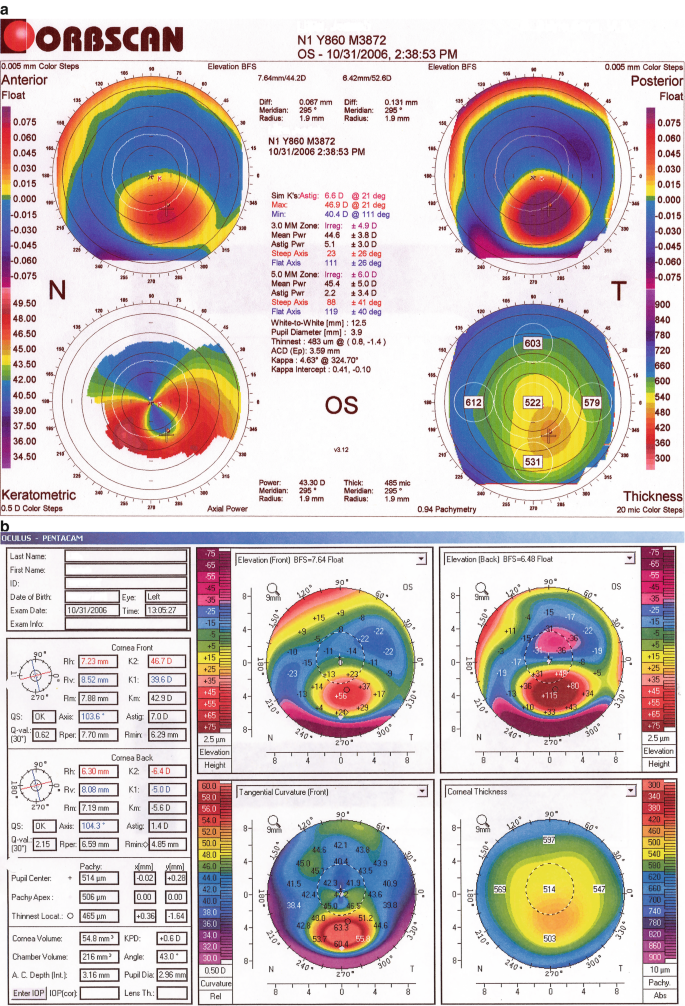 Corneal Ectasia | Springer Nature Link