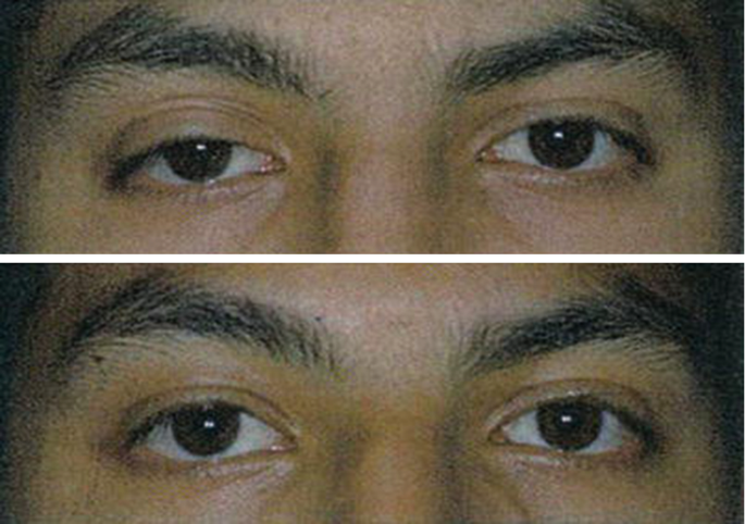 Ptosis | Springer Nature Link (formerly SpringerLink)