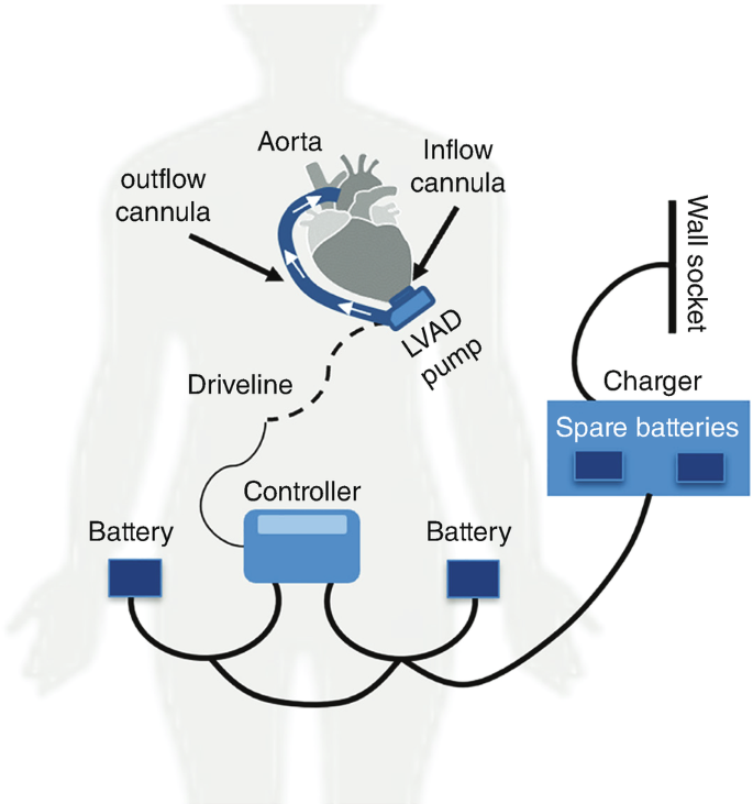 Heart Transplant and Ventricular Assist Devices | SpringerLink