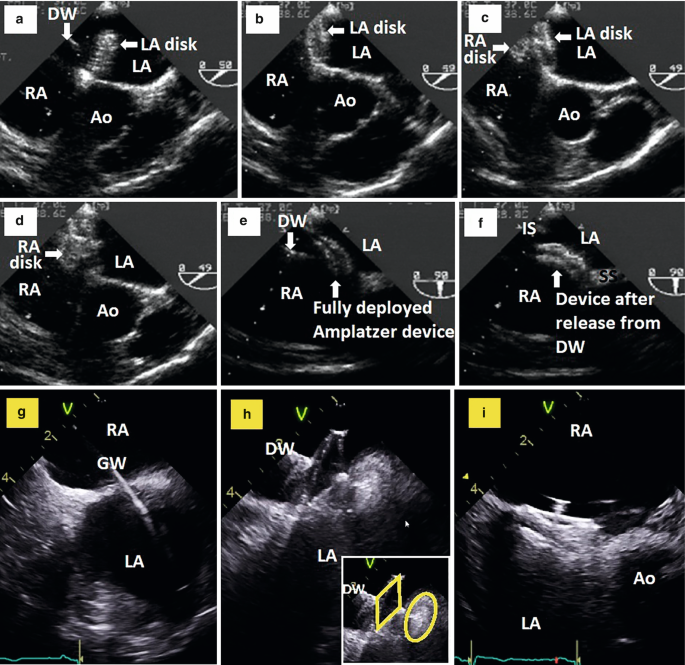 Percutaneous Device Closure of Atrial Septal Defect (ASD) and Patent ...