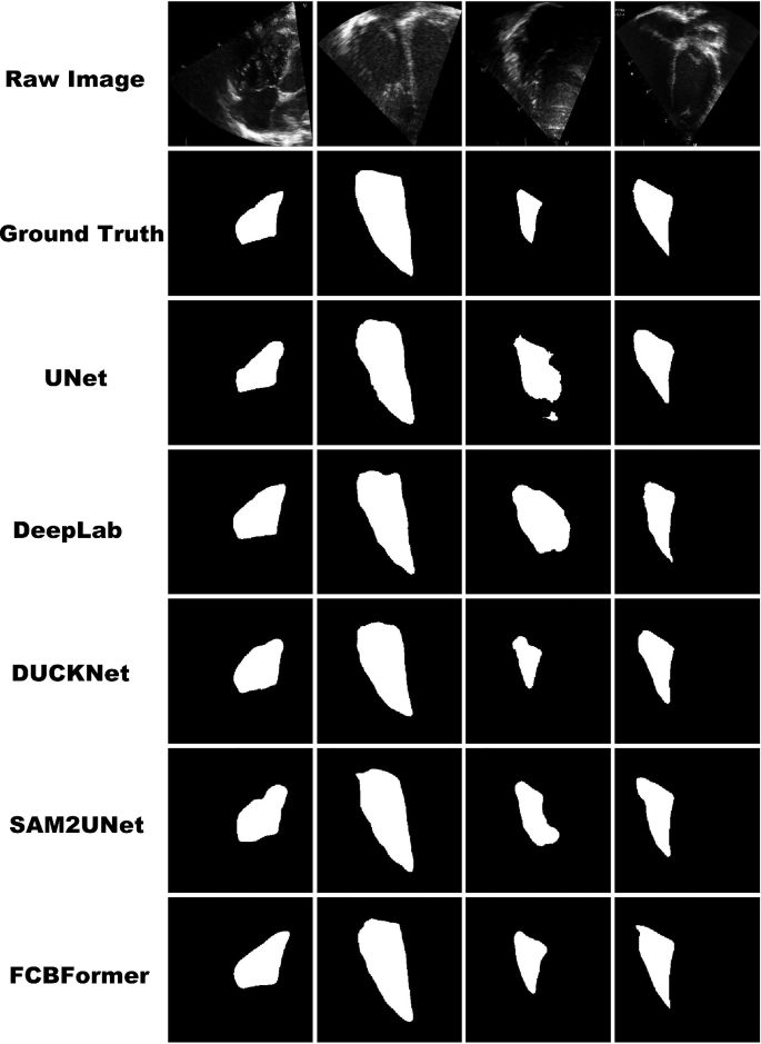 Deep Learning for Pediatric Right Ventricle Segmentation in ...