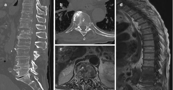 Vertebral Osteomyelitis and Tuberculosis | SpringerLink