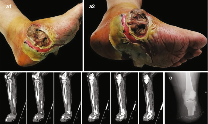 Diabetic Foot Osteomyelitis (DFO) | SpringerLink