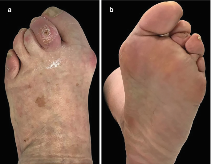 Diabetic Foot Osteomyelitis (DFO) | SpringerLink