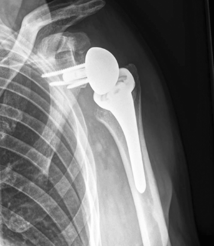PJI After Shoulder and Elbow Arthroplasty | SpringerLink
