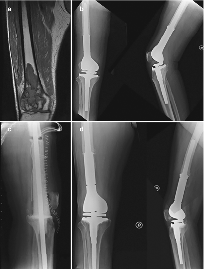 Periprosthetic Joint Infection in Megaprostheses | SpringerLink