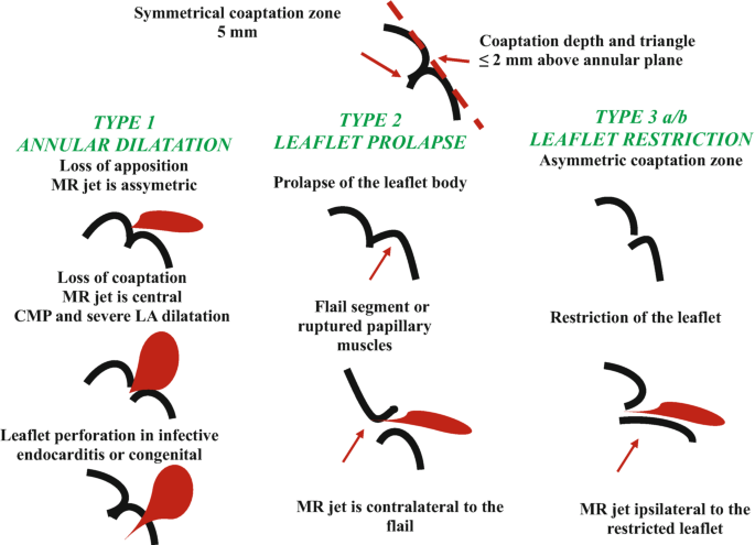 Heart Failure and Mitral Regurgitation—What We Need to Know? | SpringerLink