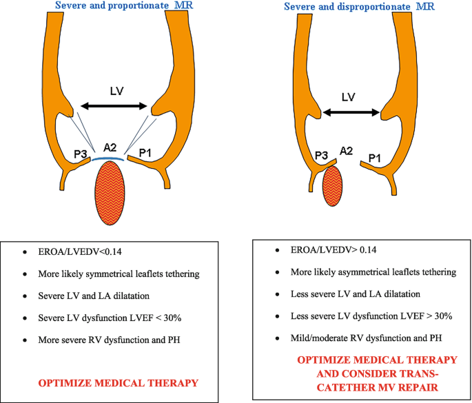 Heart Failure and Mitral Regurgitation—What We Need to Know? | SpringerLink