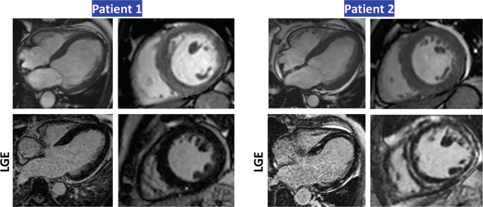 Role of Cardiovascular Magnetic Resonance Imaging in Heart Failure ...