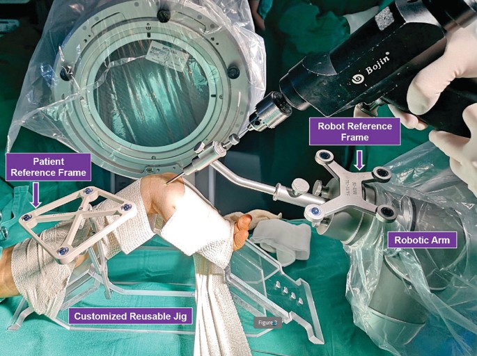 Robotic-Assisted Wrist Surgery | Springer Nature Link (formerly ...