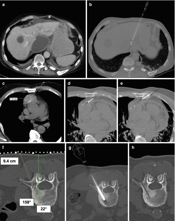 CT-Guided Interventions: Indications, Technique, and Pitfalls ...