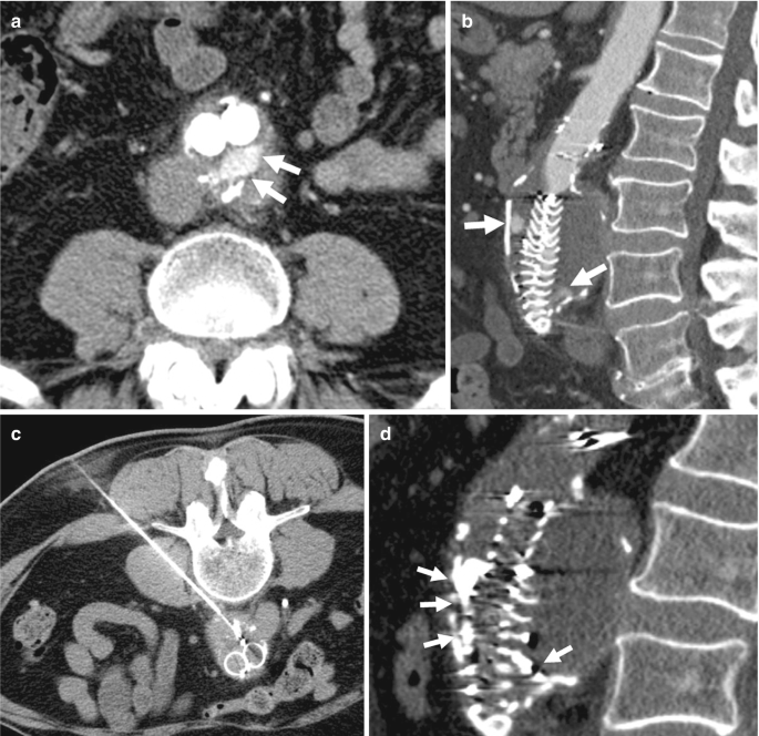 Special Techniques: Percutaneous Management of Endoleaks | Springer ...