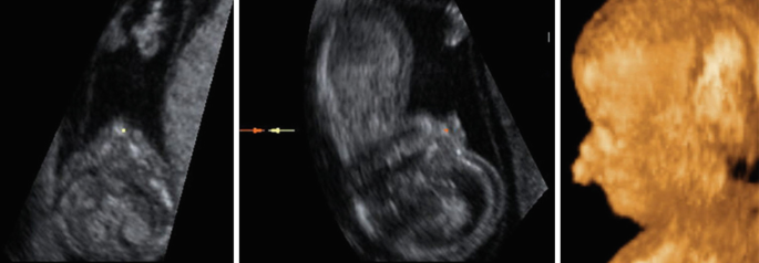 Evaluation of the Fetal Face in the First Trimester | SpringerLink
