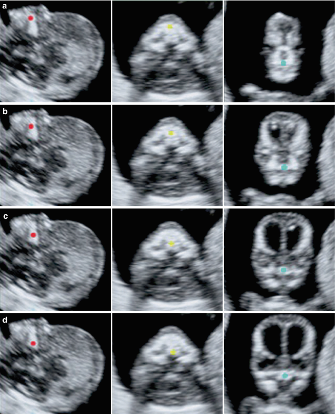 Evaluation of the Fetal Face in the First Trimester | SpringerLink