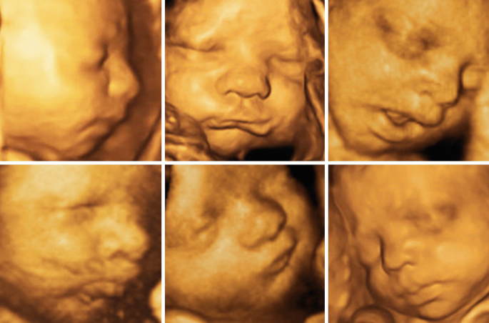 2D/3D/4D Ultrasound of the Fetal Face in Genetic Syndromes | SpringerLink