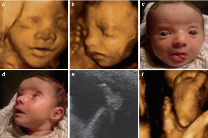 2D/3D/4D Ultrasound of the Fetal Face in Genetic Syndromes | SpringerLink