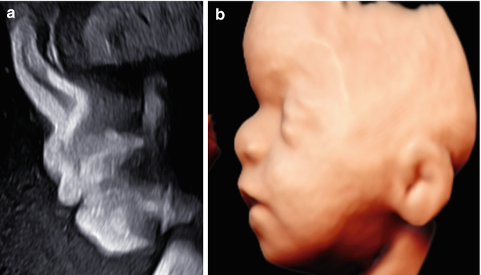 2D/3D/4D Ultrasound of the Fetal Face in Genetic Syndromes | SpringerLink