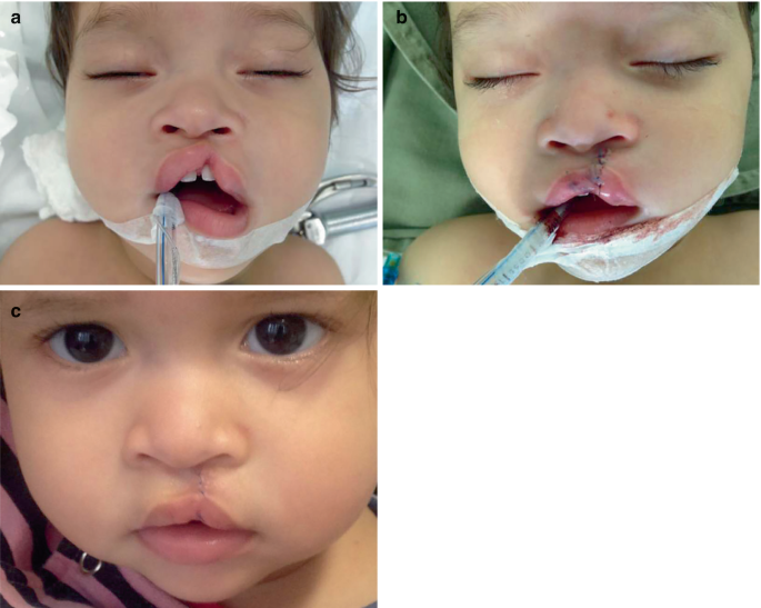 Postnatal Management of Cleft Lip and Palate | Springer Nature Link