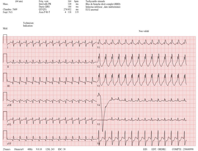 ECG 14 | SpringerLink