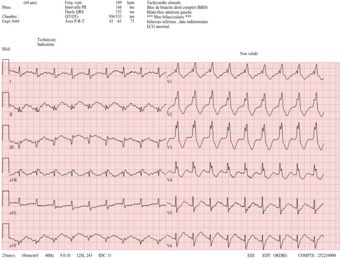 ECG 14 | SpringerLink