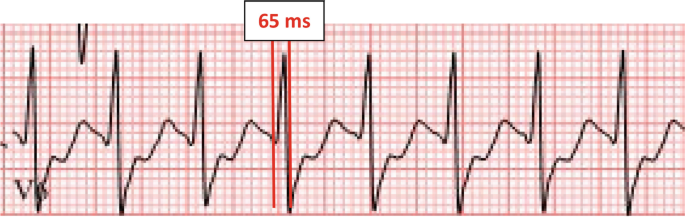 ECG 14 | SpringerLink