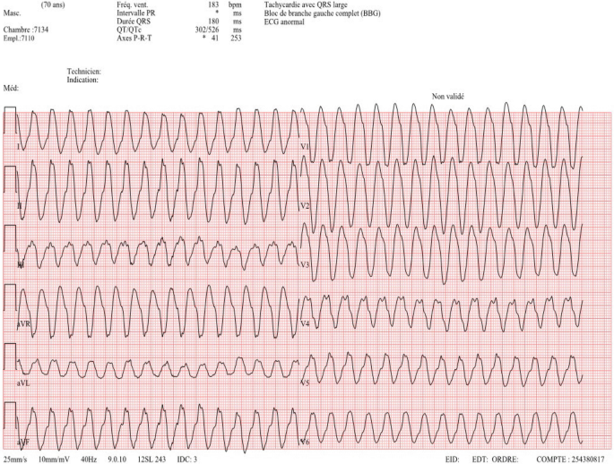ECG 16 | SpringerLink