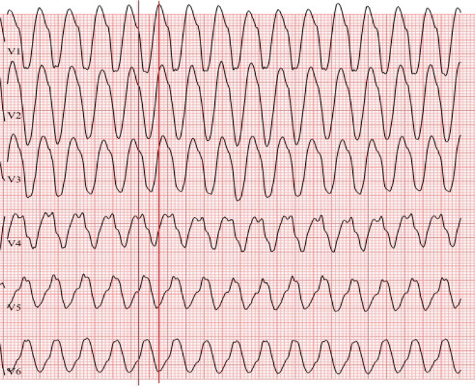 ECG 16 | SpringerLink