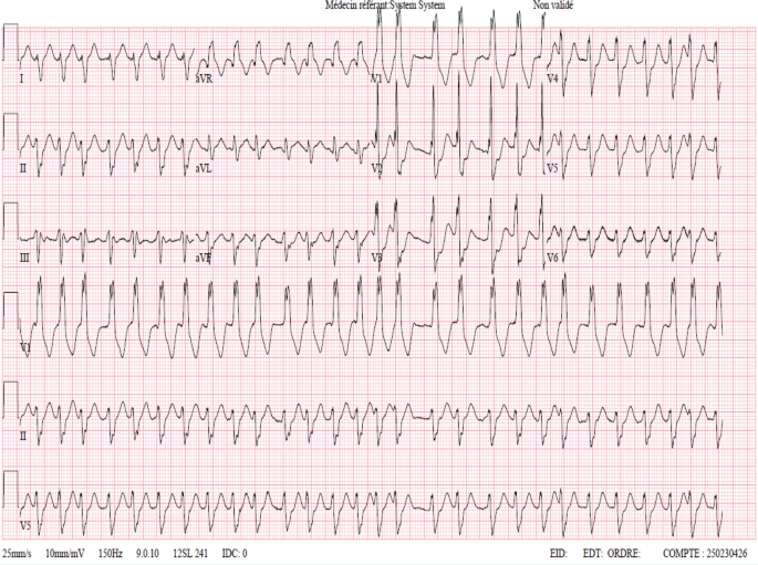 ECG 18 | SpringerLink
