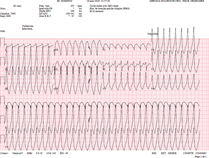 ECG 1 | SpringerLink