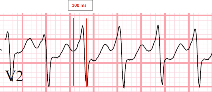 ECG 1 | SpringerLink