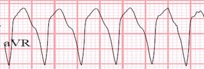 ECG 1 | SpringerLink