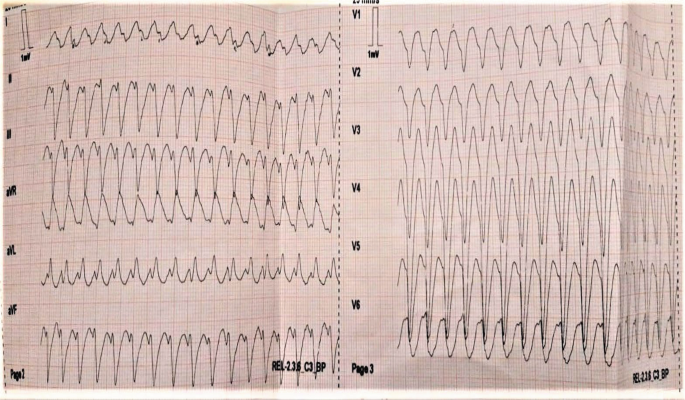 ECG 20 | SpringerLink