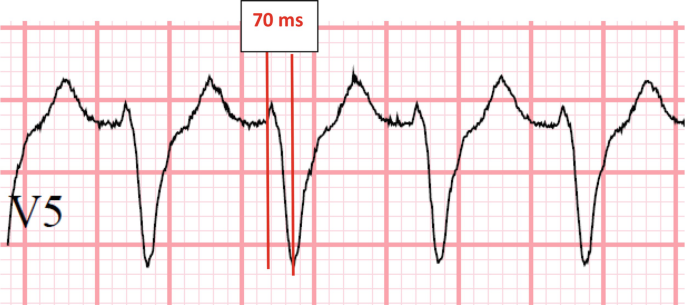 ECG 21 | SpringerLink