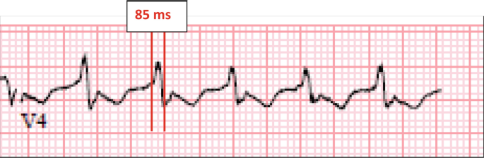 ECG 28 | Springer Nature Link