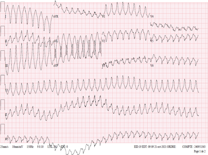 ECG 30 | SpringerLink