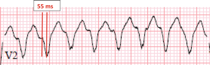 ECG 30 | SpringerLink