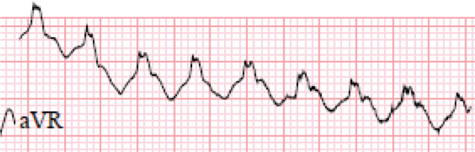 ECG 30 | SpringerLink