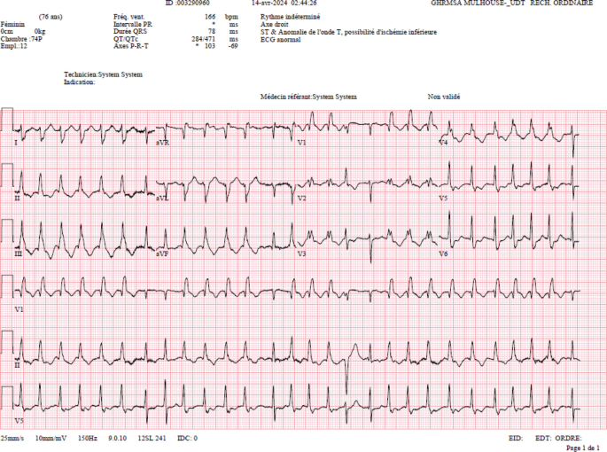ECG 42 | SpringerLink
