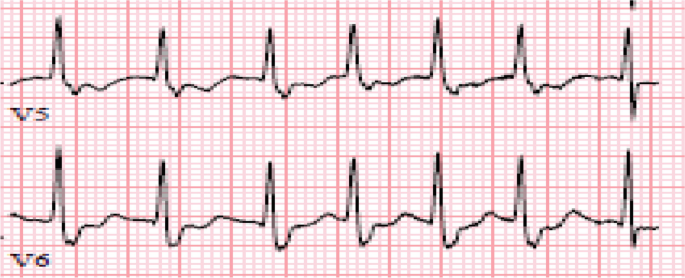 ECG 42 | SpringerLink