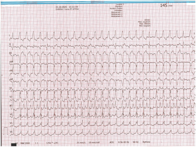 ECG 44 | Springer Nature Link