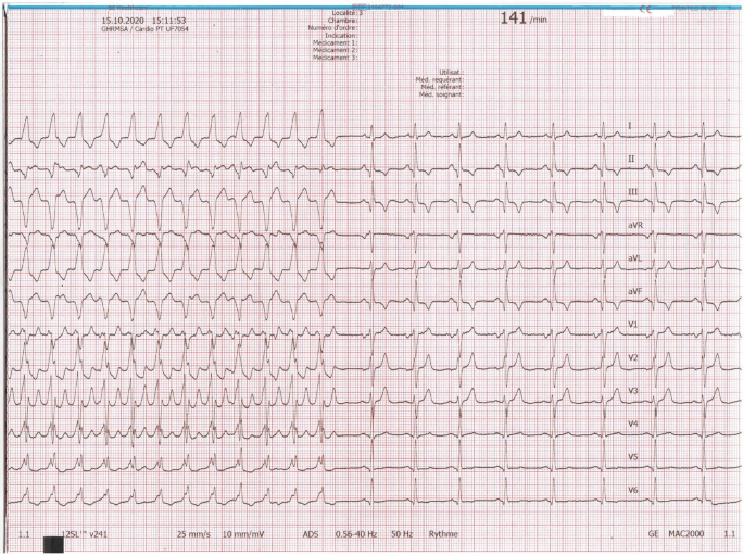 ECG 44 | SpringerLink