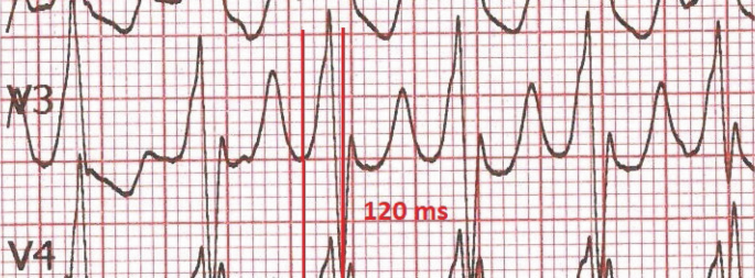 ECG 44 | SpringerLink