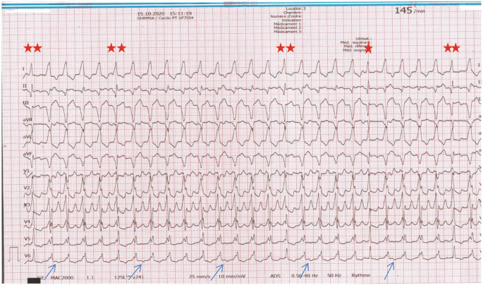 ECG 44 | SpringerLink