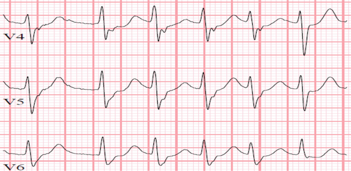 ECG 4 | Springer Nature Link