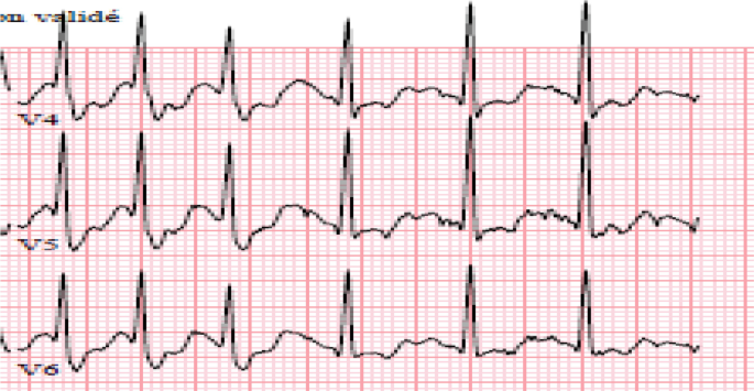 ECG 50 | SpringerLink