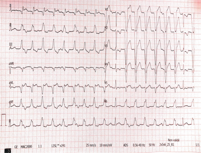 ECG 6 | Springer Nature Link