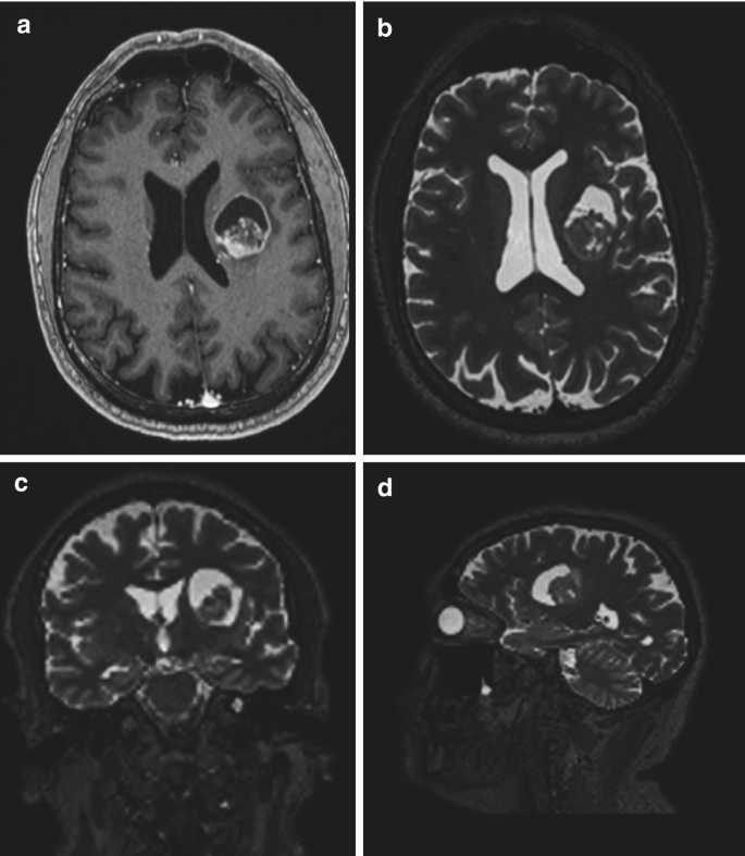 Combining nTMS and Tractography for Language Mapping: An Integrated ...
