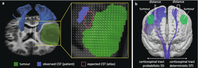 Harnessing Advanced Tractography in Neurosurgical Practice | SpringerLink